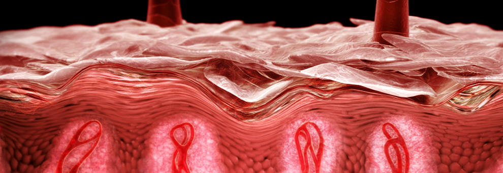 Severe Psoriasis - Managing a flare-up – Verduracare.com